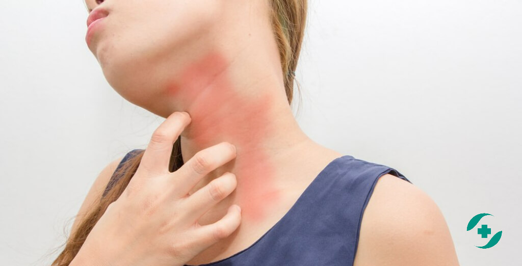 Аллергия на алкоголь: признаки, причины, опасность состояния | Лечение ...